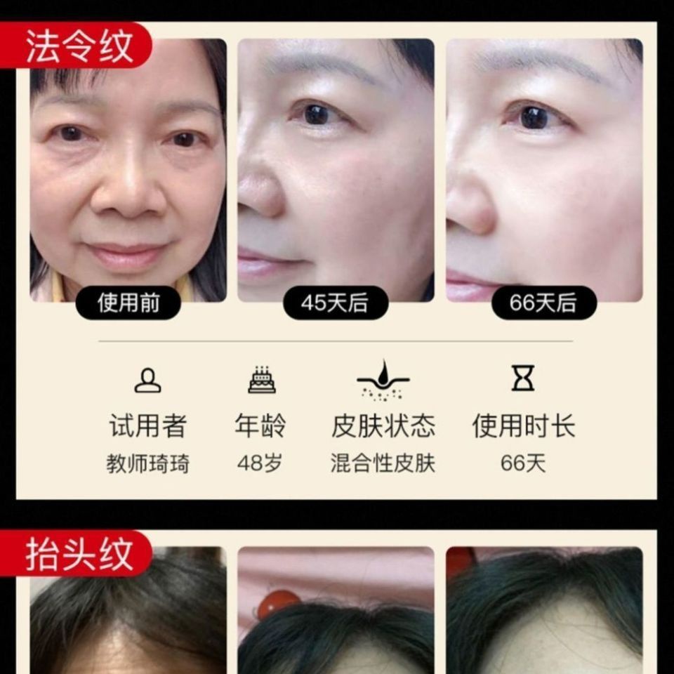 Go to wrinkles, botox, smear the original bacillus, anti-wrinkle, anti ...