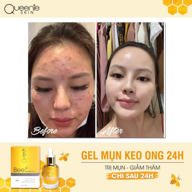 keo bee ong mun hieu qua trong vòng 24h | Shopee Việt Nam