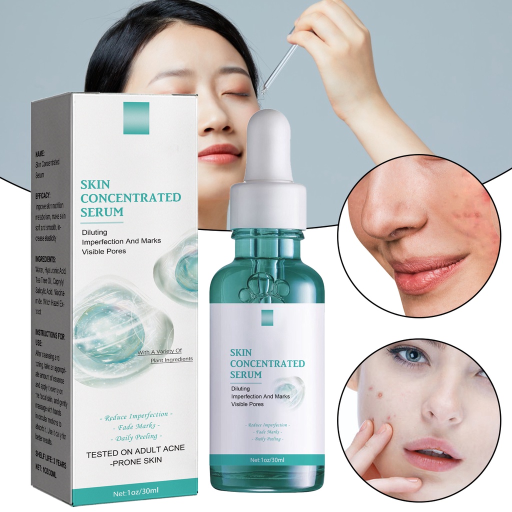 Skin Concentrated Serum Acne Treatment Essence Oil Control Face Skin ...