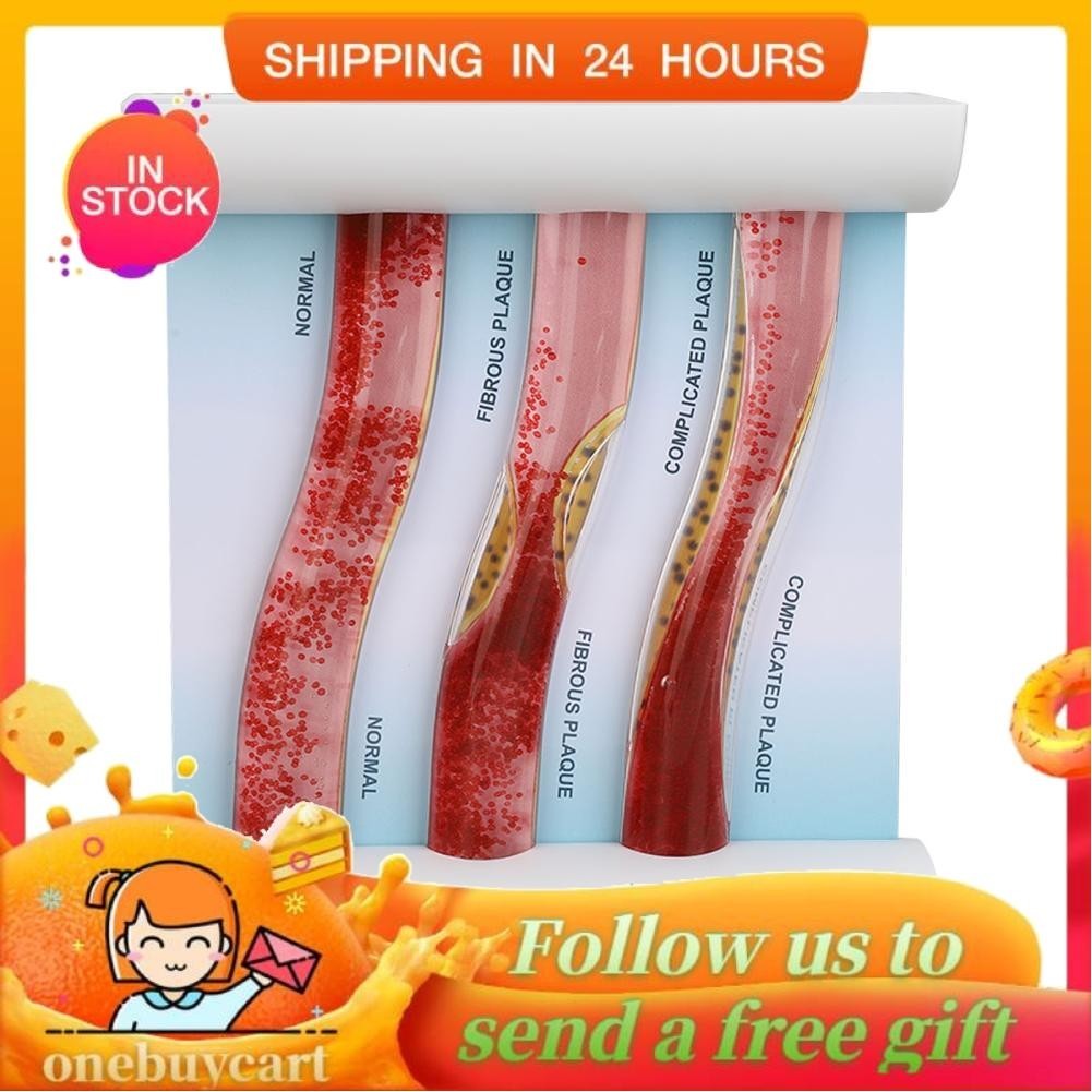 Lipoprotein LDL Blood Vessel Model Low Density Lipid Obstructi ACM ...