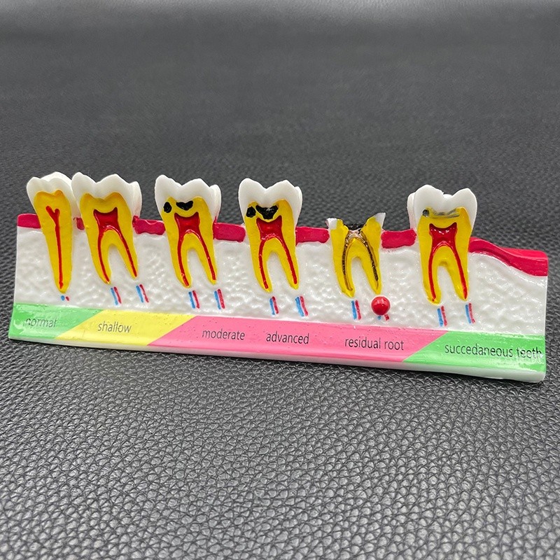 Mô hình nha khoa Caries Phân loại Mô hình răng Răng Caries Tiến hóa Mô ...