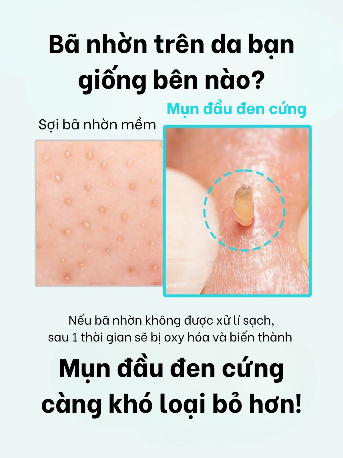 [ ilso Official] COMBO 2 Ủ MỤN _ Tinh chất ủ mụn đầu đen +TInh chất ủ mụn trứng cá Tặng kèm dụng ...