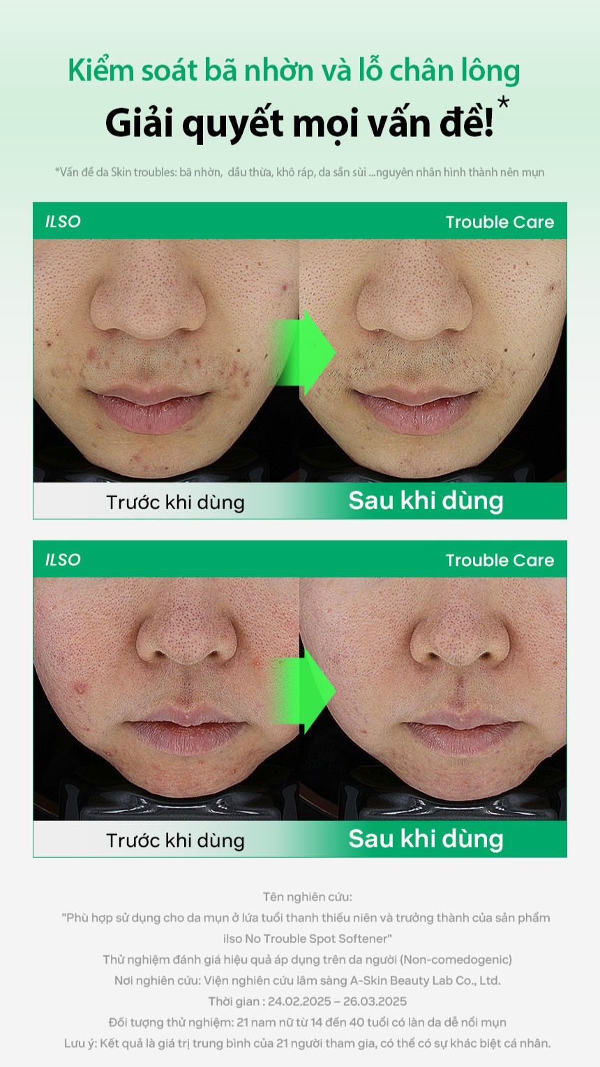 [ ilso Official] COMBO 2 Ủ MỤN _ Tinh chất ủ mụn đầu đen +TInh chất ủ mụn trứng cá Tặng kèm dụng ...