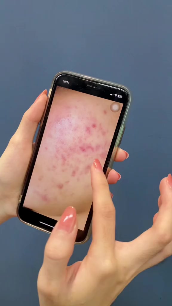 Sample Tinh Chất Niacinamide 5% + Zinc 1% Hỗ Trợ Mụn Bioverse B351 Acne ...