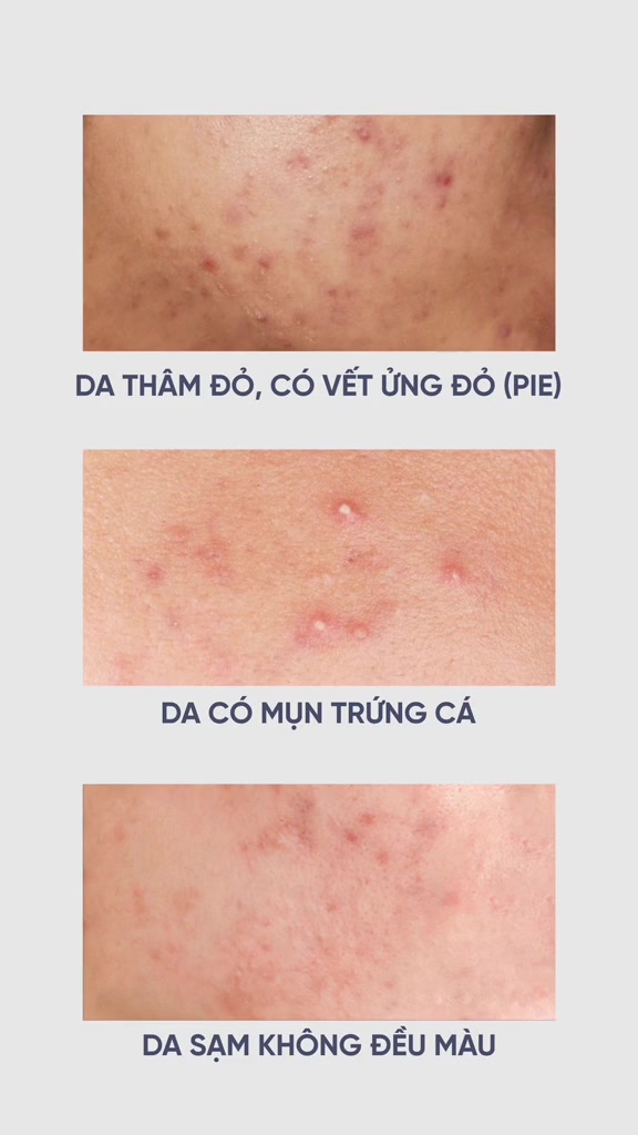 Tinh Chất Niacinamide 5% + Zinc 1% Hỗ Trợ Mụn Bioverse B351 Acne Clear ...