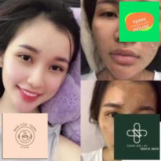 PEEL DA TCA 50% Peel da sinh học đến từ Mỹ | Shopee Việt Nam