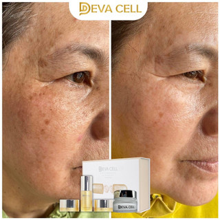 Bộ Phân Hủy Nám LUXURY DevaCell - Deva cell | Shopee Việt Nam