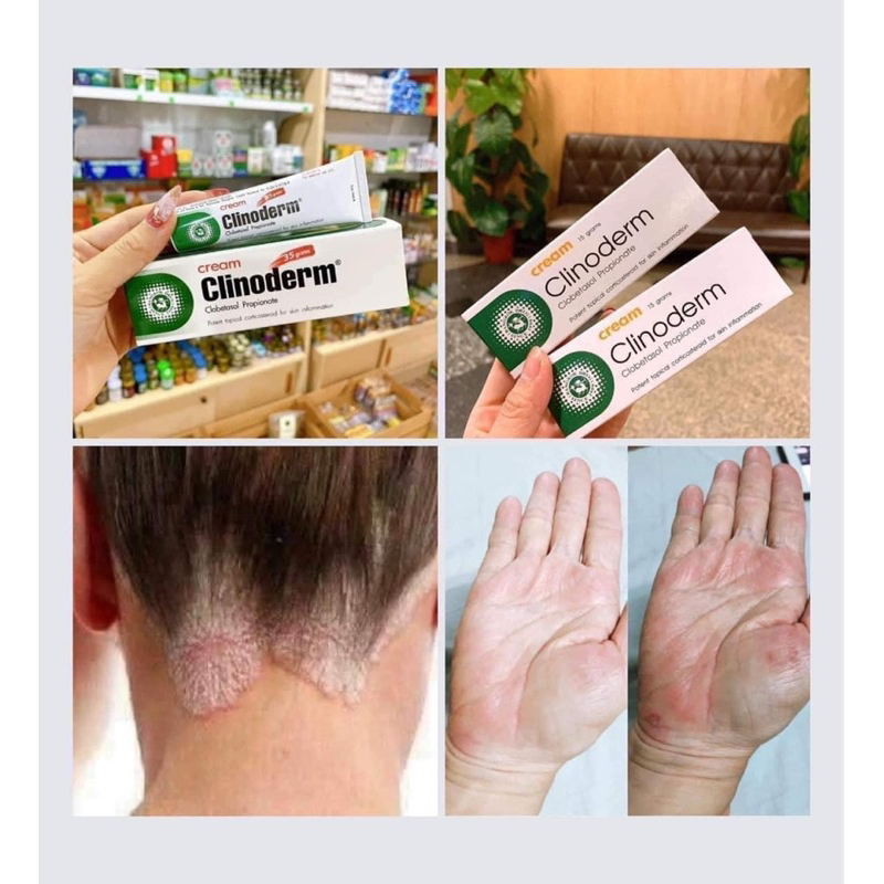 [HÀNG NỘI ĐỊA CÓ Bill] Kem Bôi Vảy Nến Khô Da Clinoderm Thái Lan 15G ...