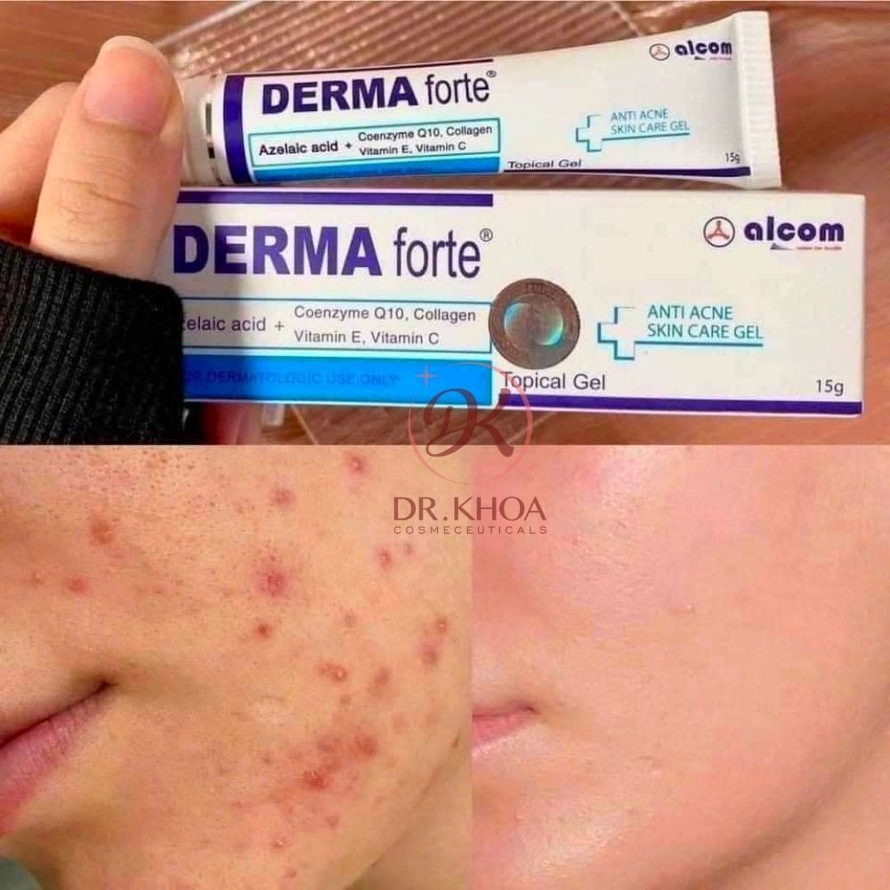 Gel Giảm Mụn Ngừa Thâm Gamma Derma Forte Bản Thường, Advanced 15g | Shopee Việt Nam