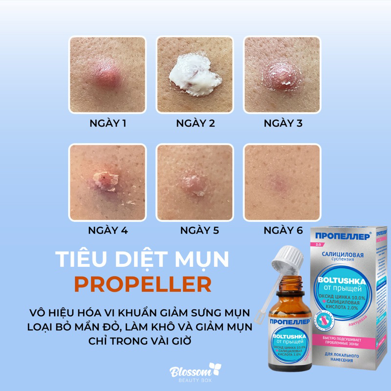 Dung dịch kẽm chấm mụn hiệu quả PROPELLER Boltushka 25ml Nội địa Nga | Shopee Việt Nam