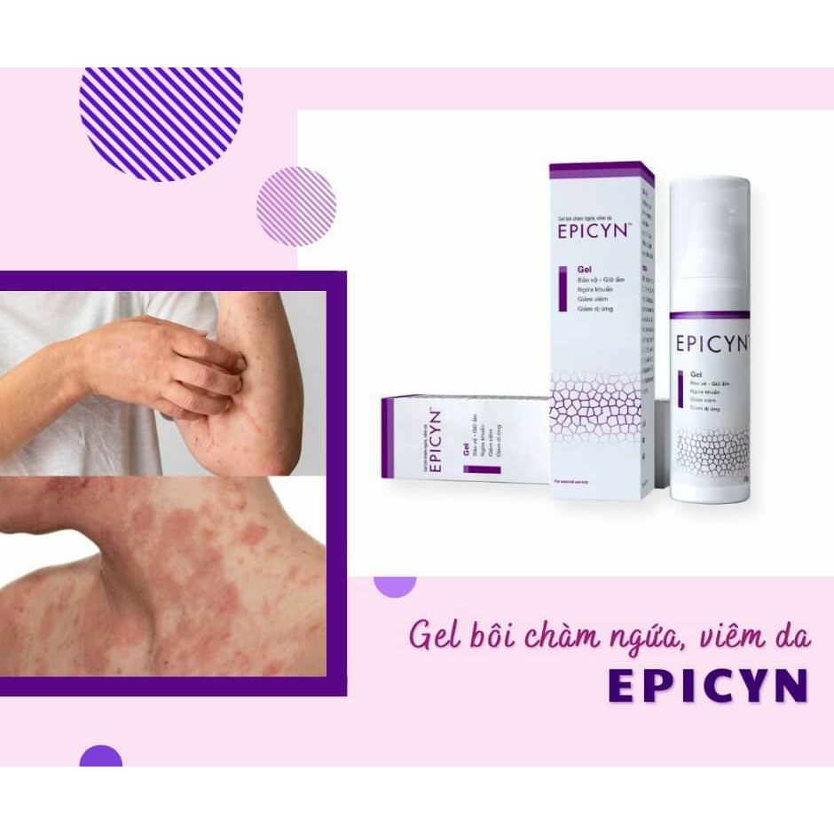 Gel viêm da cơ địa, chàm ngứa, vảy nến, viêm da dị ứng, giảm nhanh đau ...