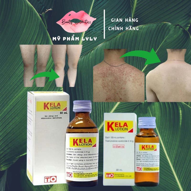 KELA LOTION DÙNG CHO VIÊM LỖ CHÂN LÔNG 30ml -60ml Thái Lan | Shopee ...