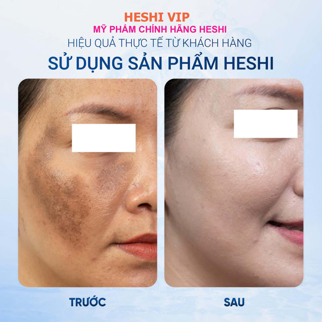 Kem nám Heshi Melasma Whitening Cream 30g chính hãng Heshi xóa mờ thâm ...