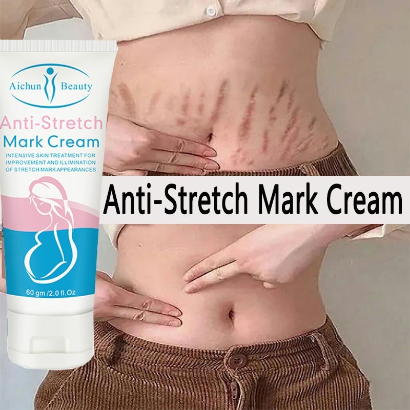 Kem Rạn Da Anti Stretch 60g - Giảm Rạn Cũ, Ngừa Rạn Mới, Dưỡng Ẩm, Mờ ...