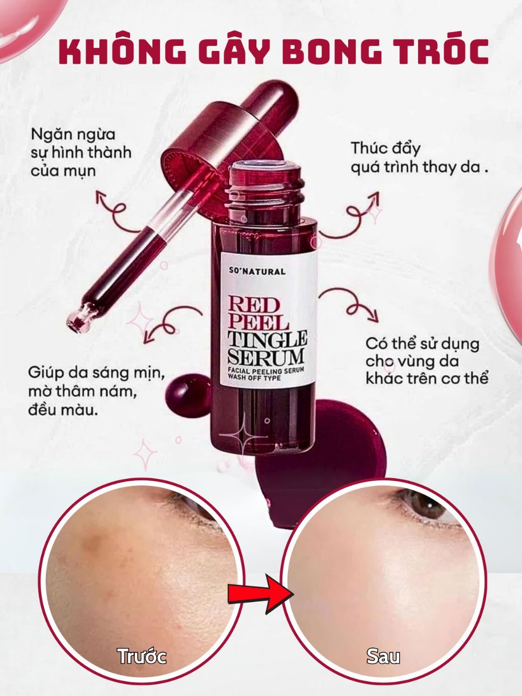 Tinh Chất Serum Peel Da Tái Tạo Da Sinh Học So Natural Red Peel Tingle Serum 11ml | Shopee Việt Nam