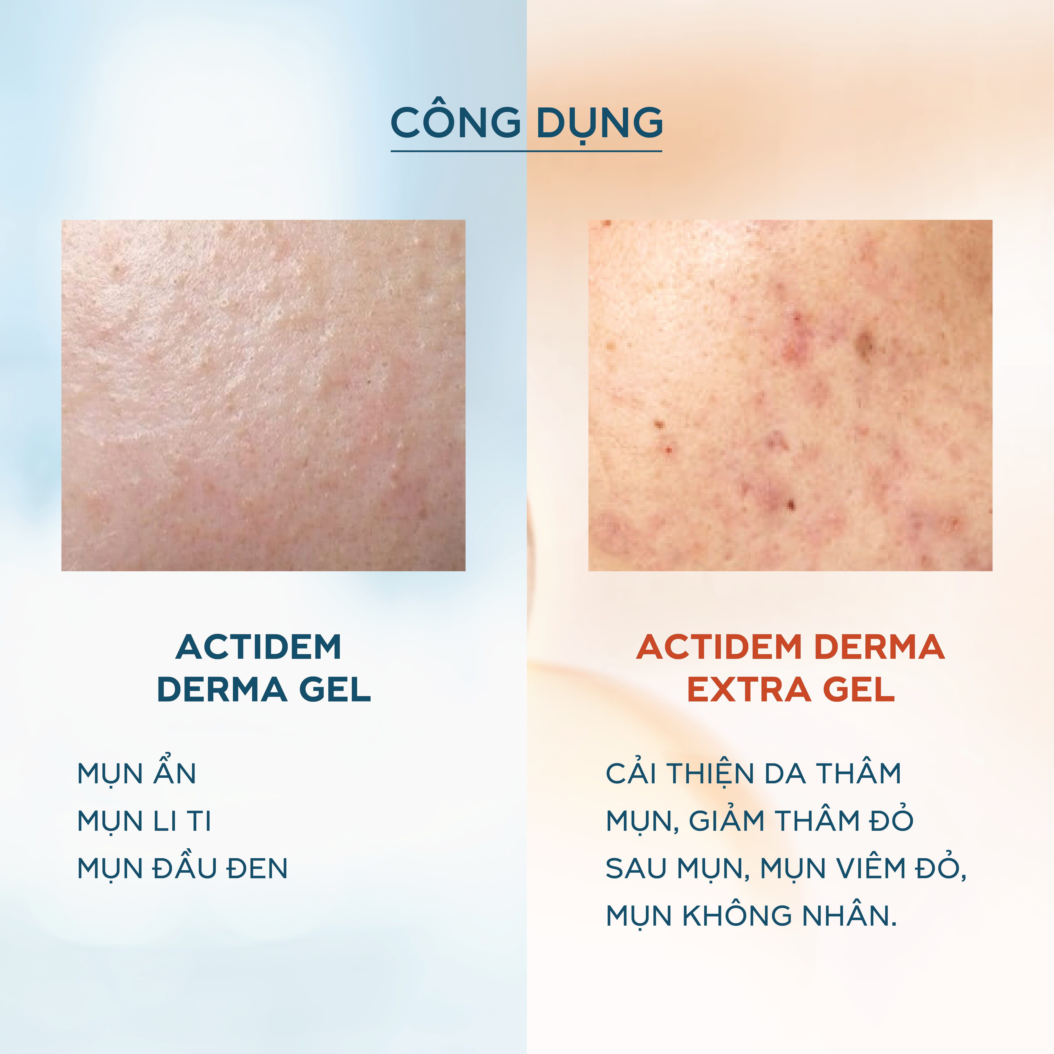 Gel giảm mụn Actidem Derma Gel 18/40gr | Shopee Việt Nam