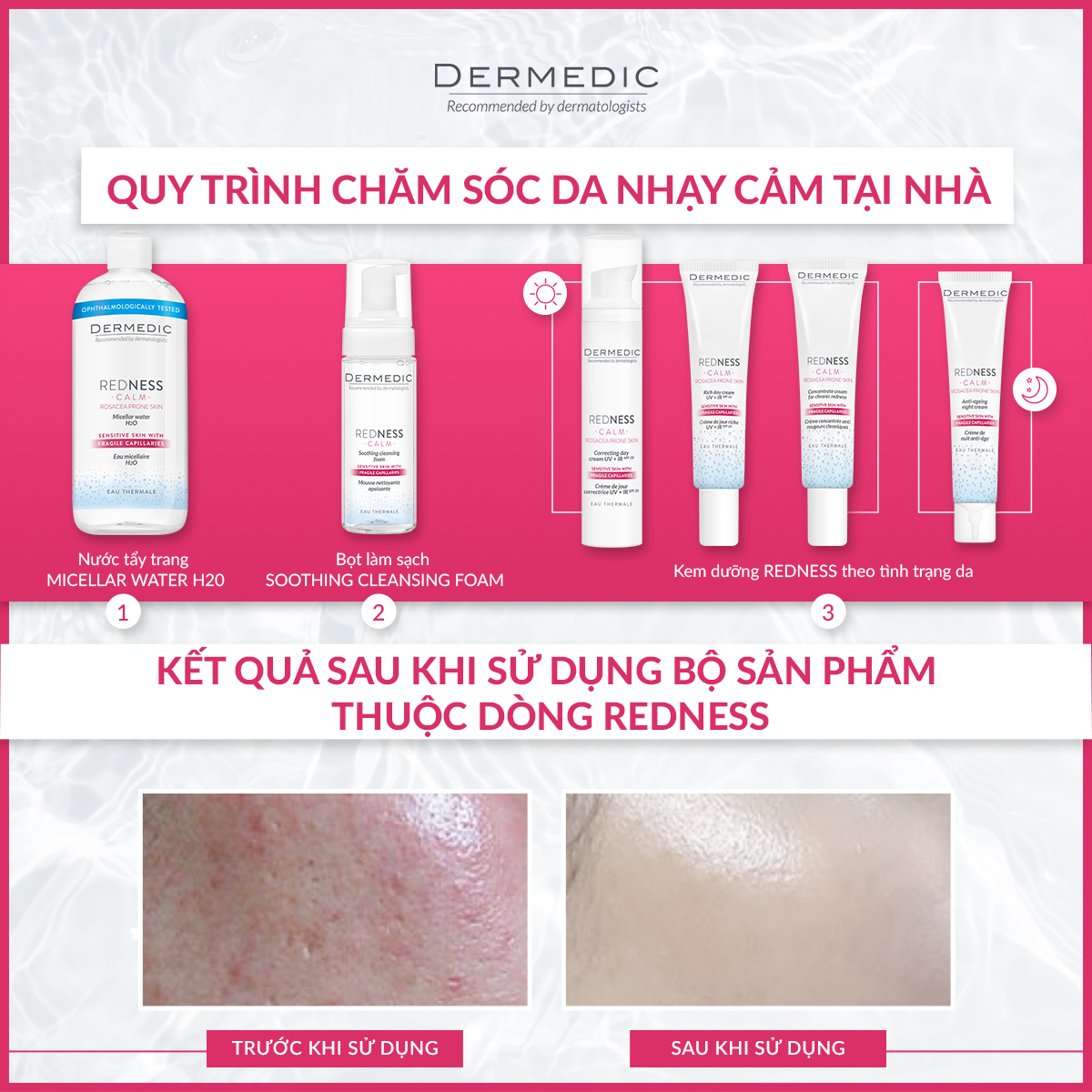 Kem dưỡng Dermedic phục hồi da mỏng yếu nhạy cảm Redness Concentrate ...