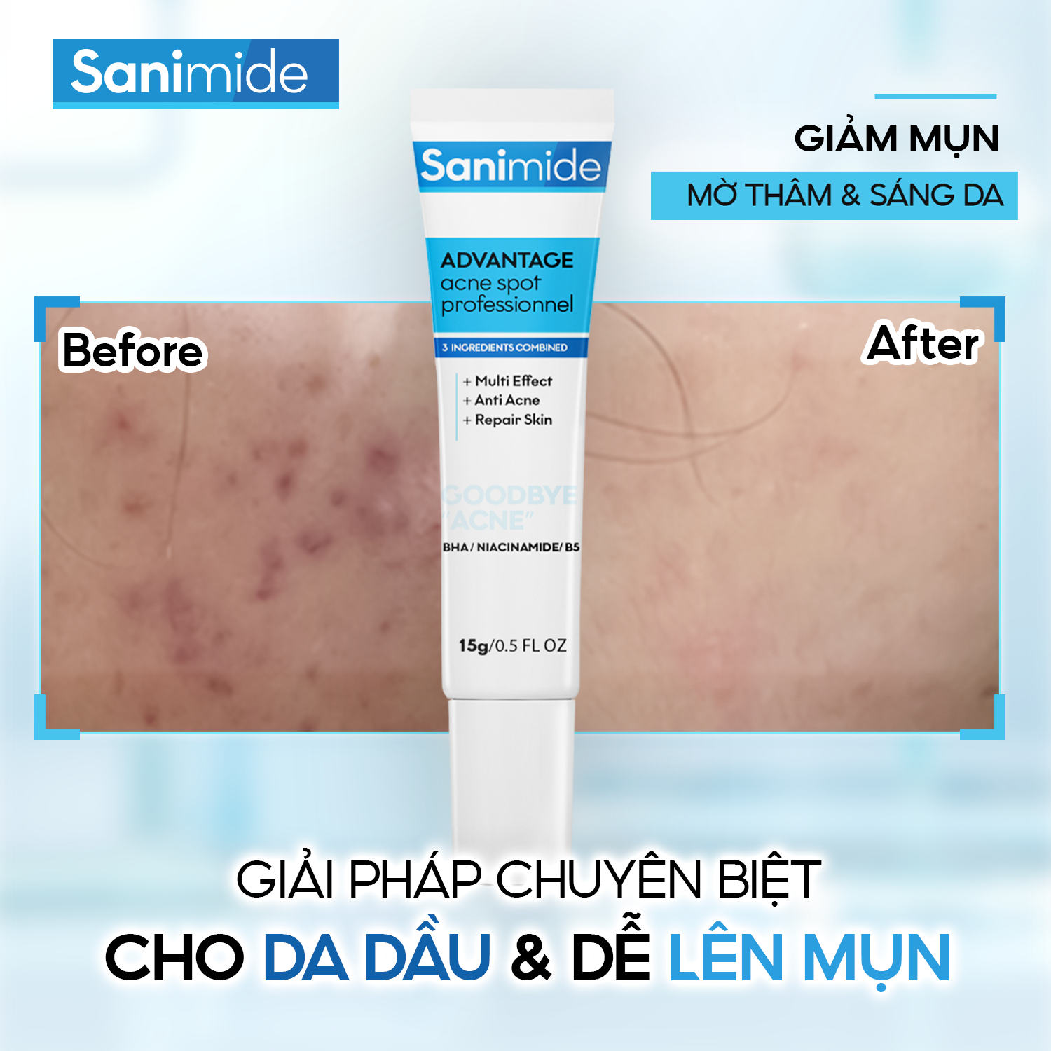 Gel Giảm Mụn Mờ Thâm Hỗ Trợ Giảm Mụn Bọc Mụn Mủ Mụn Trứng Cá Mụn