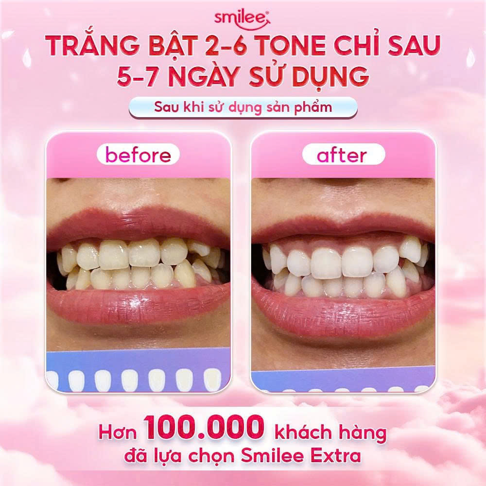 [GIÁ 577K LIVE LUCIE] Bộ Kit Trắng Răng Smilee Extra Tẩy Trắng Răng Tại ...